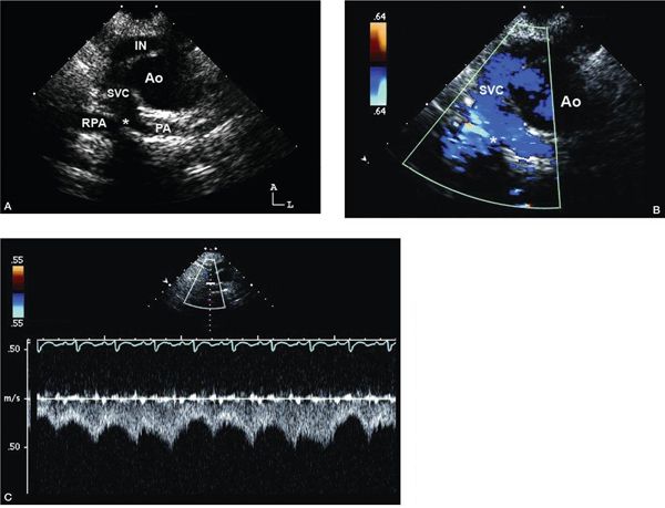 Univentricular Atrioventricular Connections | Thoracic Key