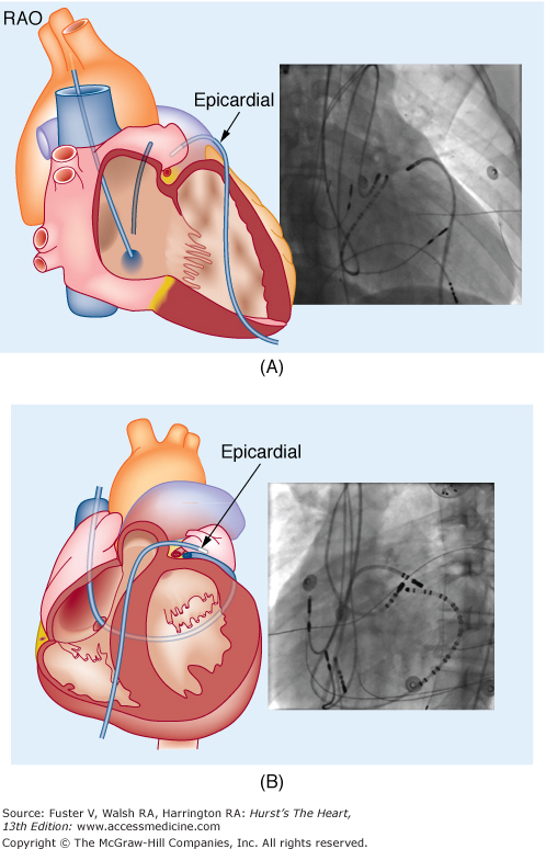Electrophysiology and Catheter-Ablative Techniques | Thoracic Key