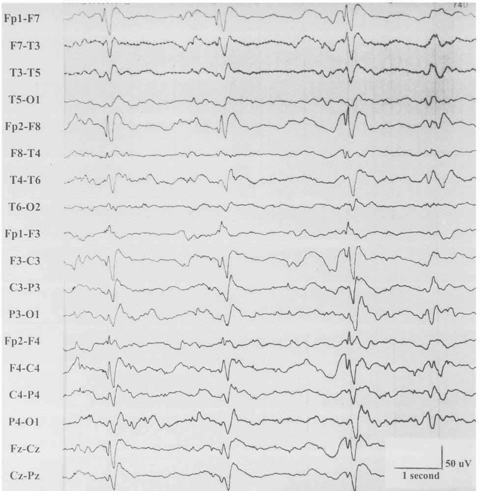 Normal Pediatric EEG: Neonates and Children | Thoracic Key
