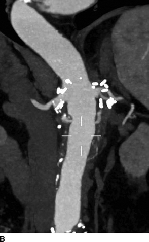 Open Abdominal Aortic Aneurysm Repair | Thoracic Key