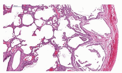 Lung Disease in Premature Infants | Thoracic Key
