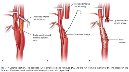 Carotid Surgery: Interposition/Endarterectomy (Including Eversion ...