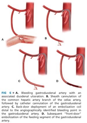 Stenting, Endografting, and Embolization Techniques: Celiac, Mesenteric ...