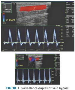 Perimalleolar Bypass and Hybrid Techniques | Thoracic Key