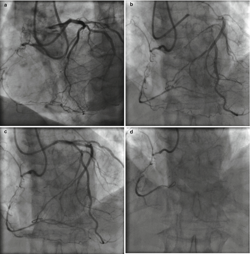 How To Fix Common Problems Encountered In Cto Pci The Expanded Hybrid