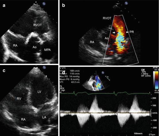 Pregnancy in Repaired Tetralogy of Fallot | Thoracic Key