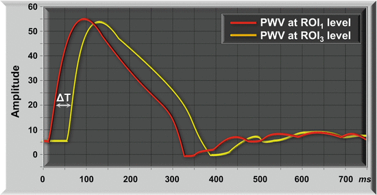 Pulse Wave Velocity and Arterial Stiffness Assessment | Thoracic Key