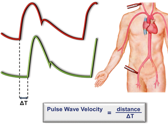 Carotid Pulse Wave