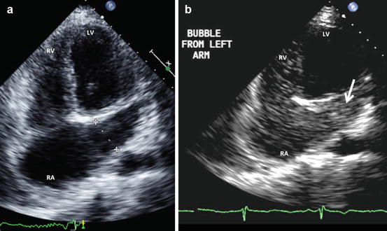 Contrast Echocardiography | Thoracic Key