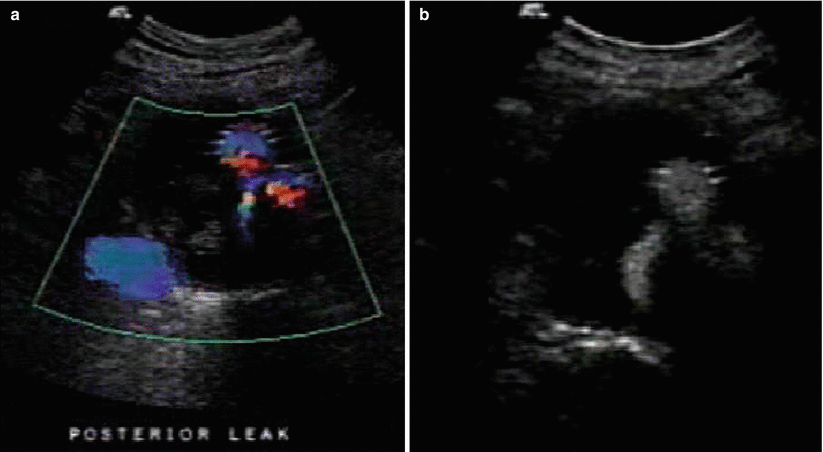 The Role of Color Duplex Ultrasound in Patients with Abdominal Aortic ...
