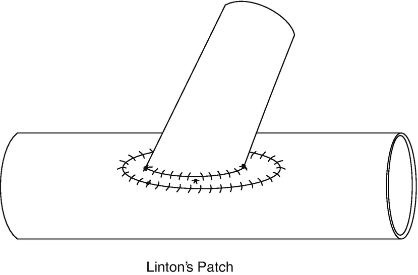 Techniques: Distal Anastomosis of an Infrainguinal Prosthetic Bypass ...