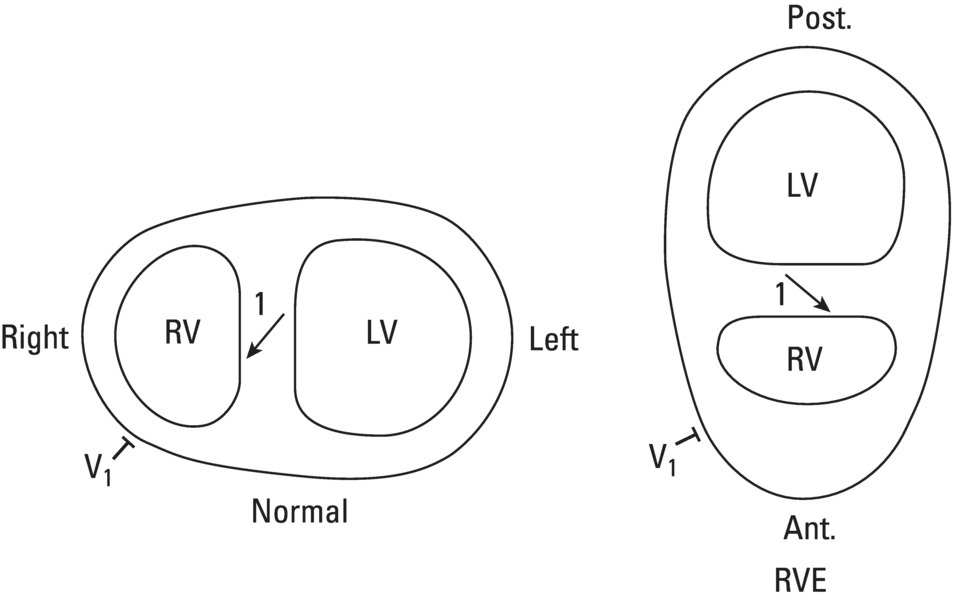 Atrial Abnormalities | Thoracic Key