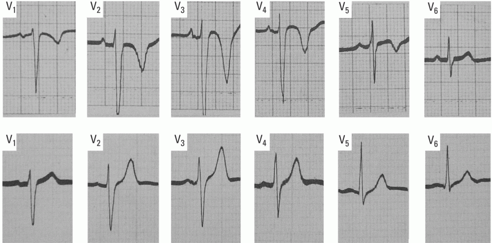 Ventricular Enlargement | Thoracic Key