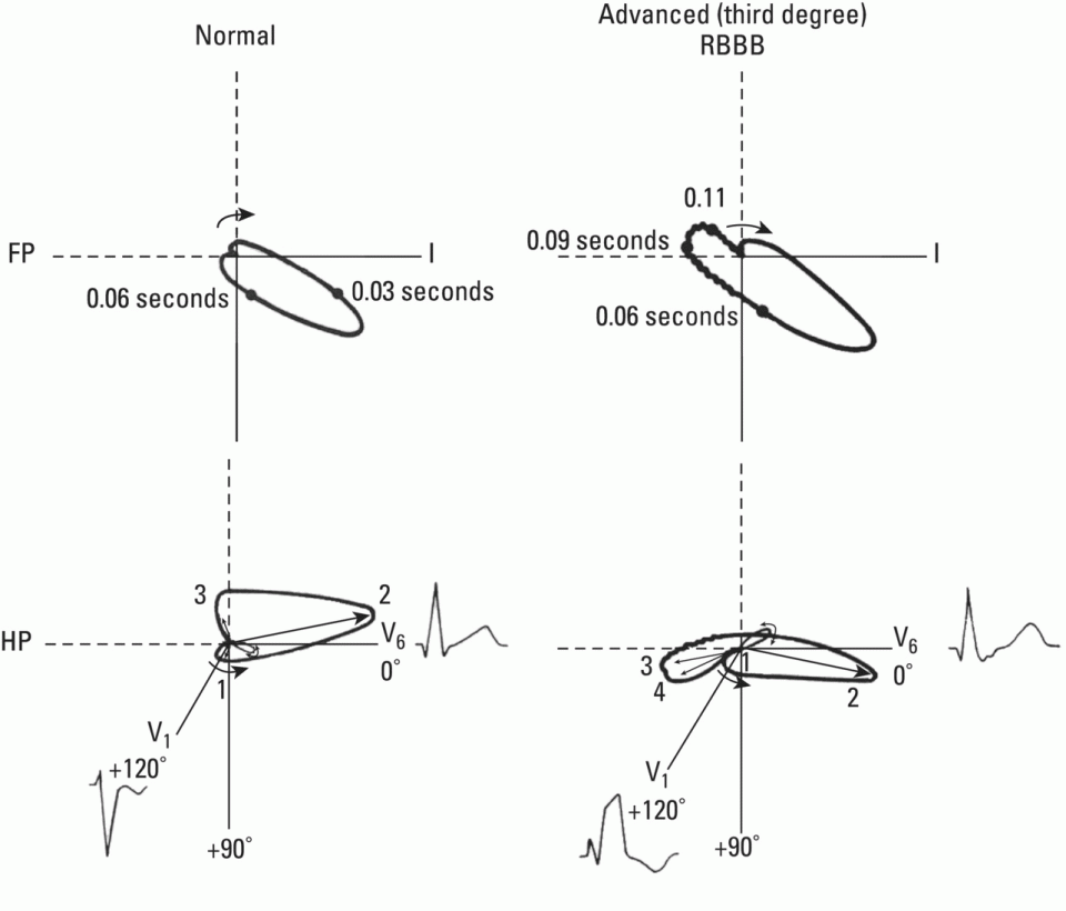 Ventricular Blocks | Thoracic Key