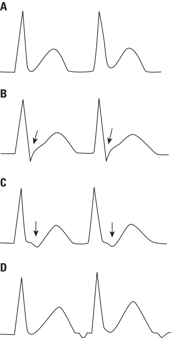 Active Supraventricular Arrhythmias | Thoracic Key