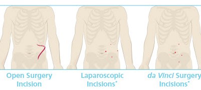 da Vinci Nephrectomy - Urology Surgeons of Oklahoma
