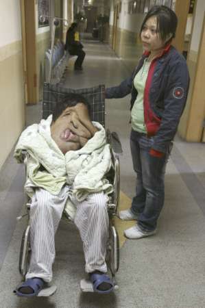 Huang Chuncai: The Elephant Man of China | The Weekly Rot