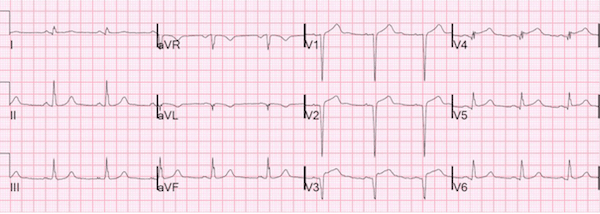 PV card: Early repolarization vs STEMI on ECG