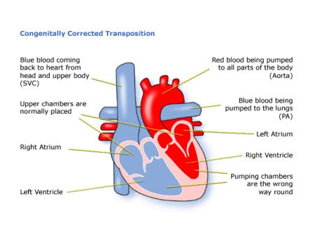 Children's Heart Federation | Congenitally Corrected Transposition