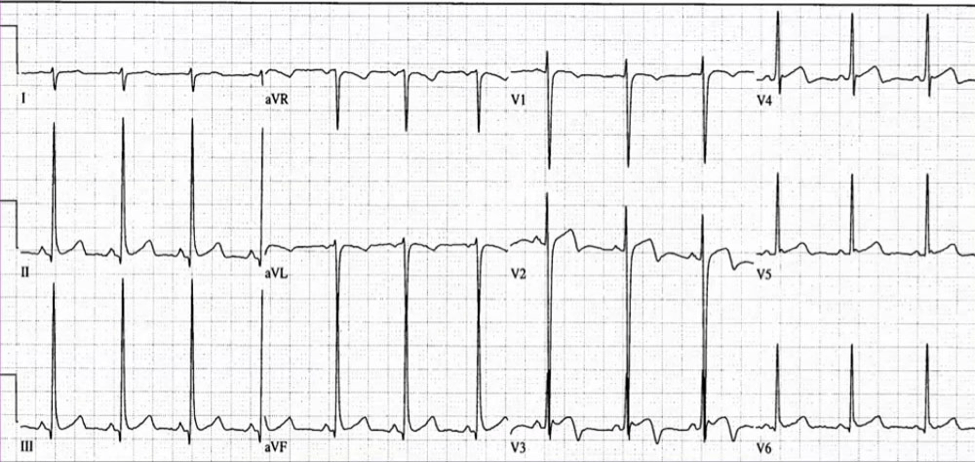Wellens' Syndrome - emdocs