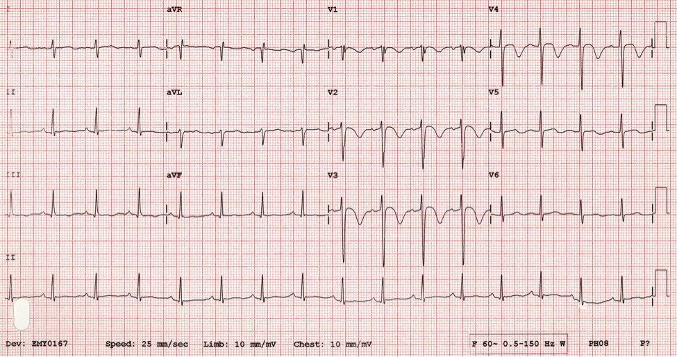 Wellens' Syndrome - emdocs