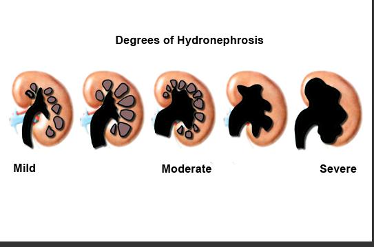 Nephrolithiasis: Diagnosis and Management in the ED - emdocs