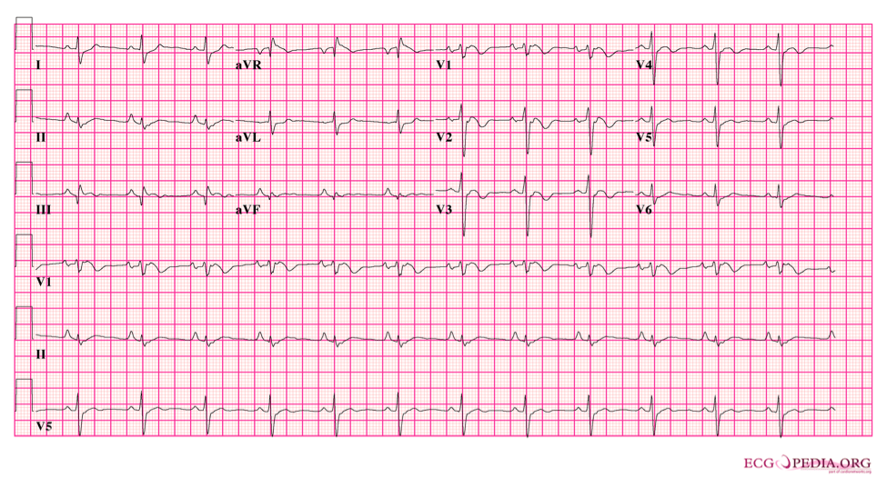 Arrhythmogenic Right Ventricular Dysplasia Ecg Arrhythmogenic Right