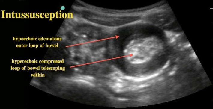 intussusception Archives - emdocs