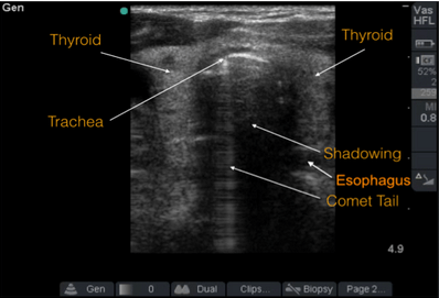 Ultrasound for Confirmation of Endotracheal Tube Placement During CPR ...