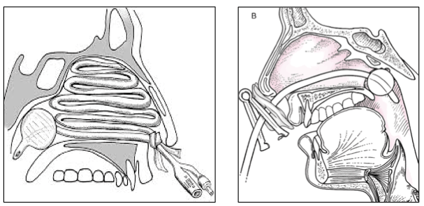 The Emergency Department Management of Posterior Epistaxis - emdocs