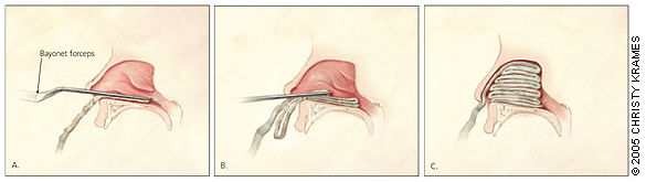 The Emergency Department Management of Posterior Epistaxis - emdocs