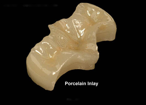 Inlays & Onlays – Moody W. Malek, D.D.S., F.A.G.D.