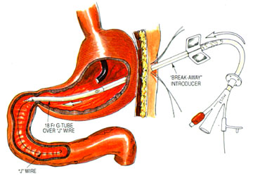 gpeg6 – Moss Tubes, Inc.