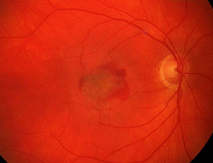AMD – Macular Degeneration Clinical Overview – OPTOMETRY EVOLUTION