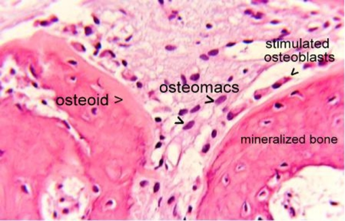 SteinerBio™ | Understanding Sclerotic Bone