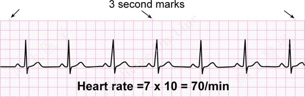 Electrocardiogram Guide (EKG/ECG) – Stepwards