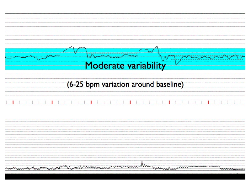 A Guide To Electronic Fetal Monitoring/Cardiotocogram – Stepwards