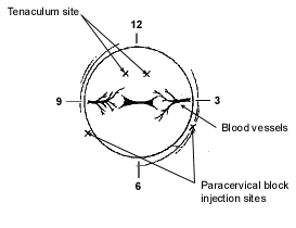 Cervical Block or Paracervical Block | Time of Care